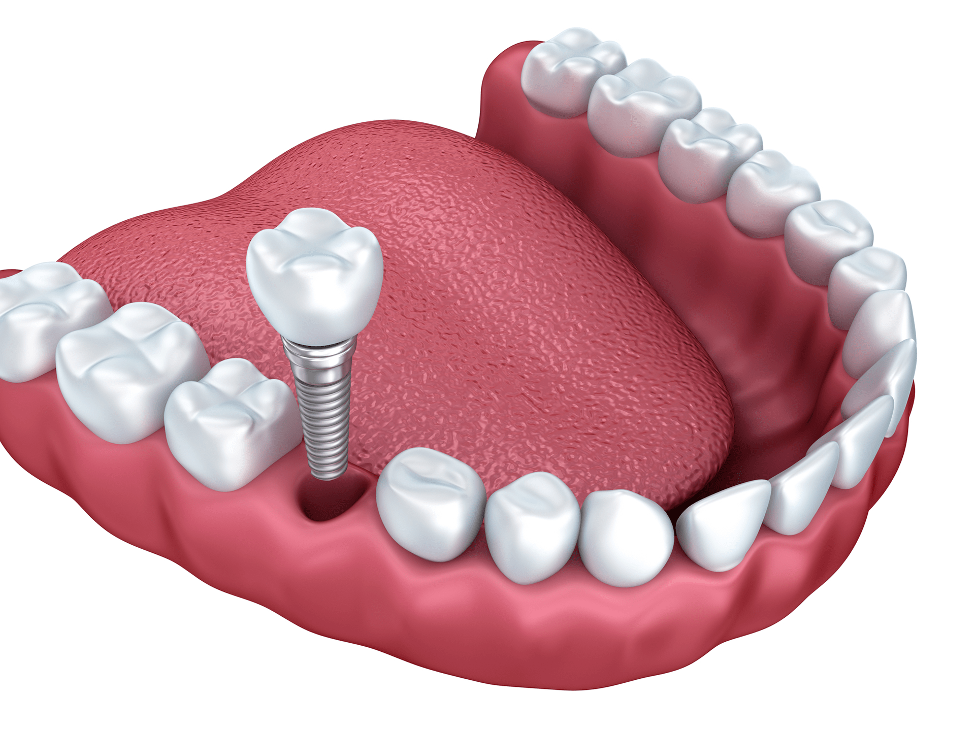 Implants | Bilby Dental
